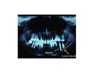 radiographic appearance of dental implant complications.pptx