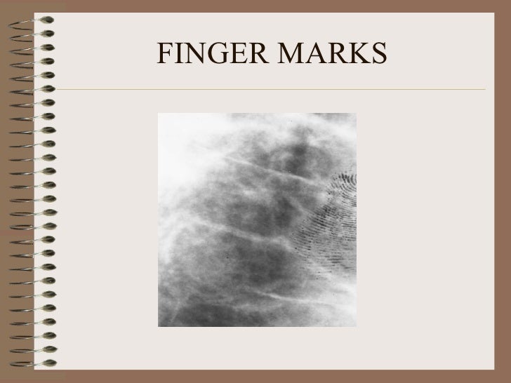 Radiographic artifacts