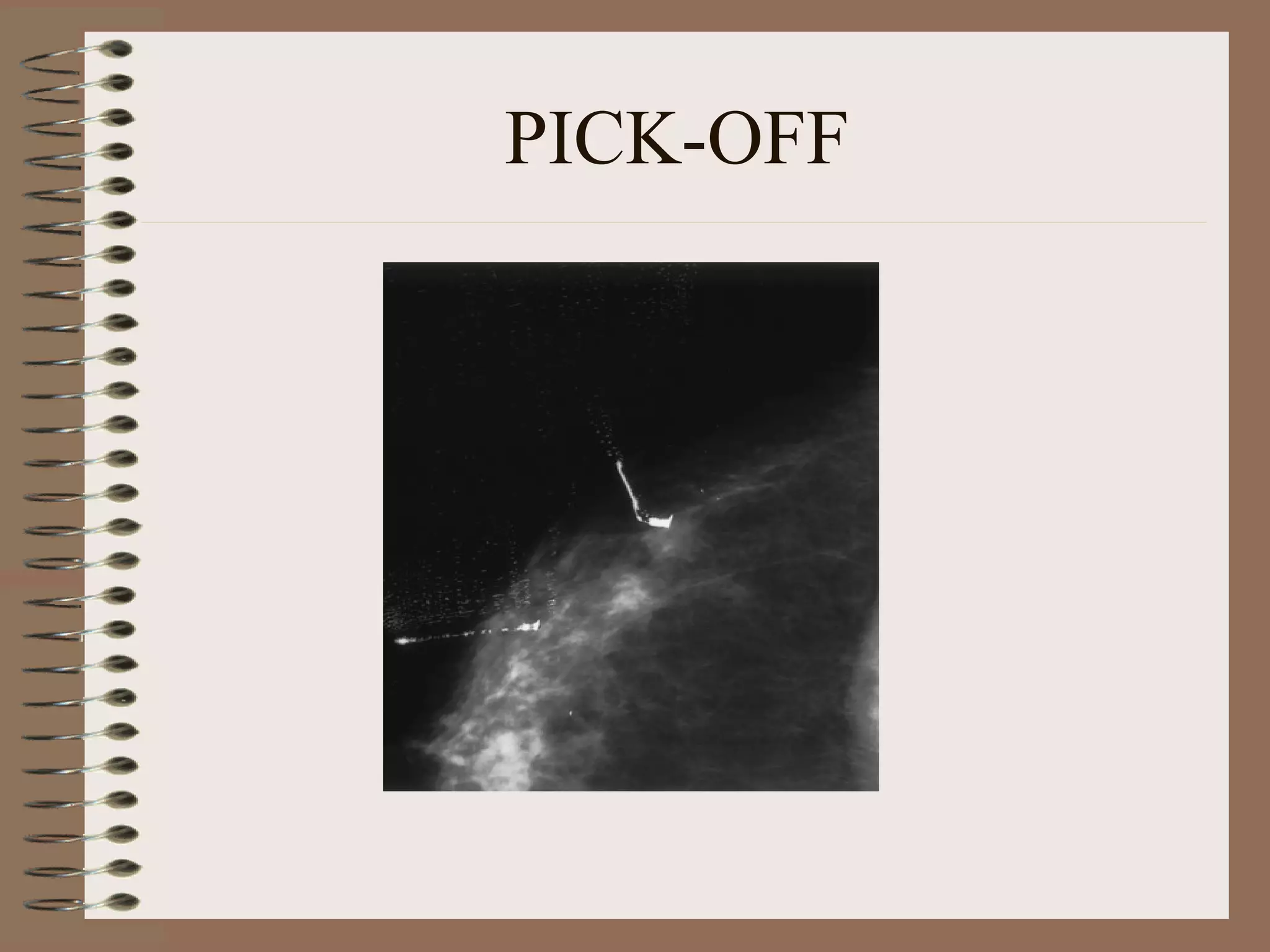 Radiographic artifacts 2 | PPT