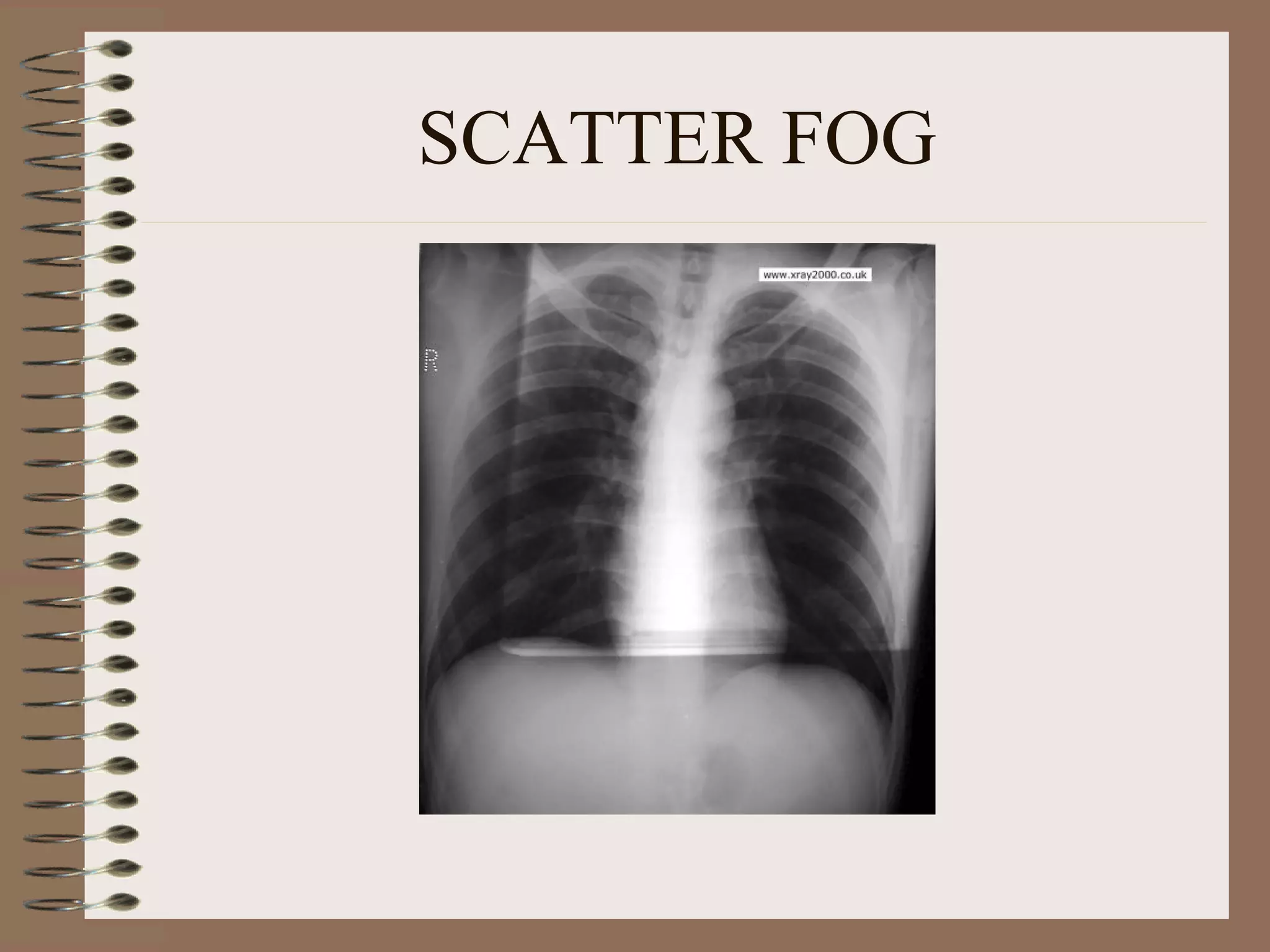 Radiographic artifacts 2 | PPT