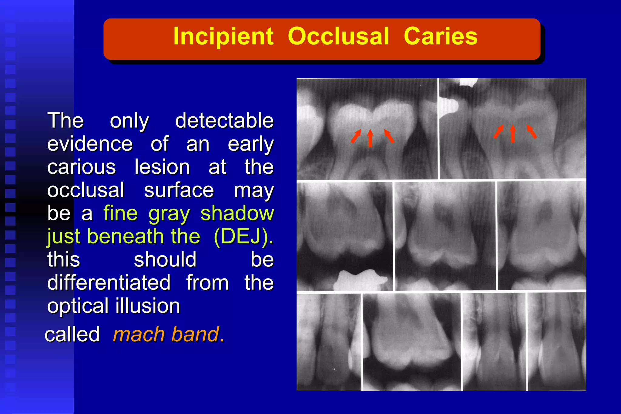 Radiographic assessment of dental caries | PPT