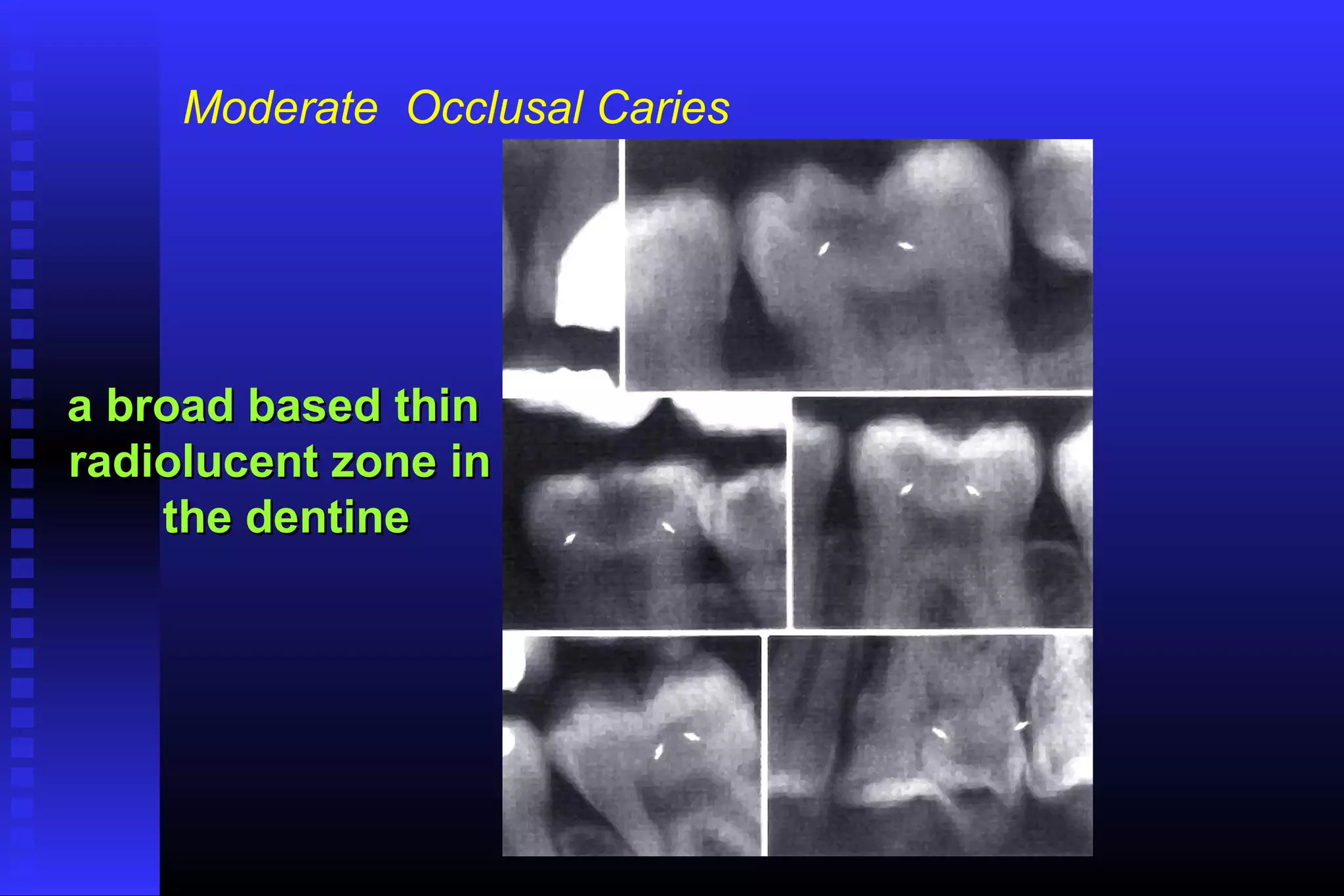 Radiographic assessment of dental caries | PPT