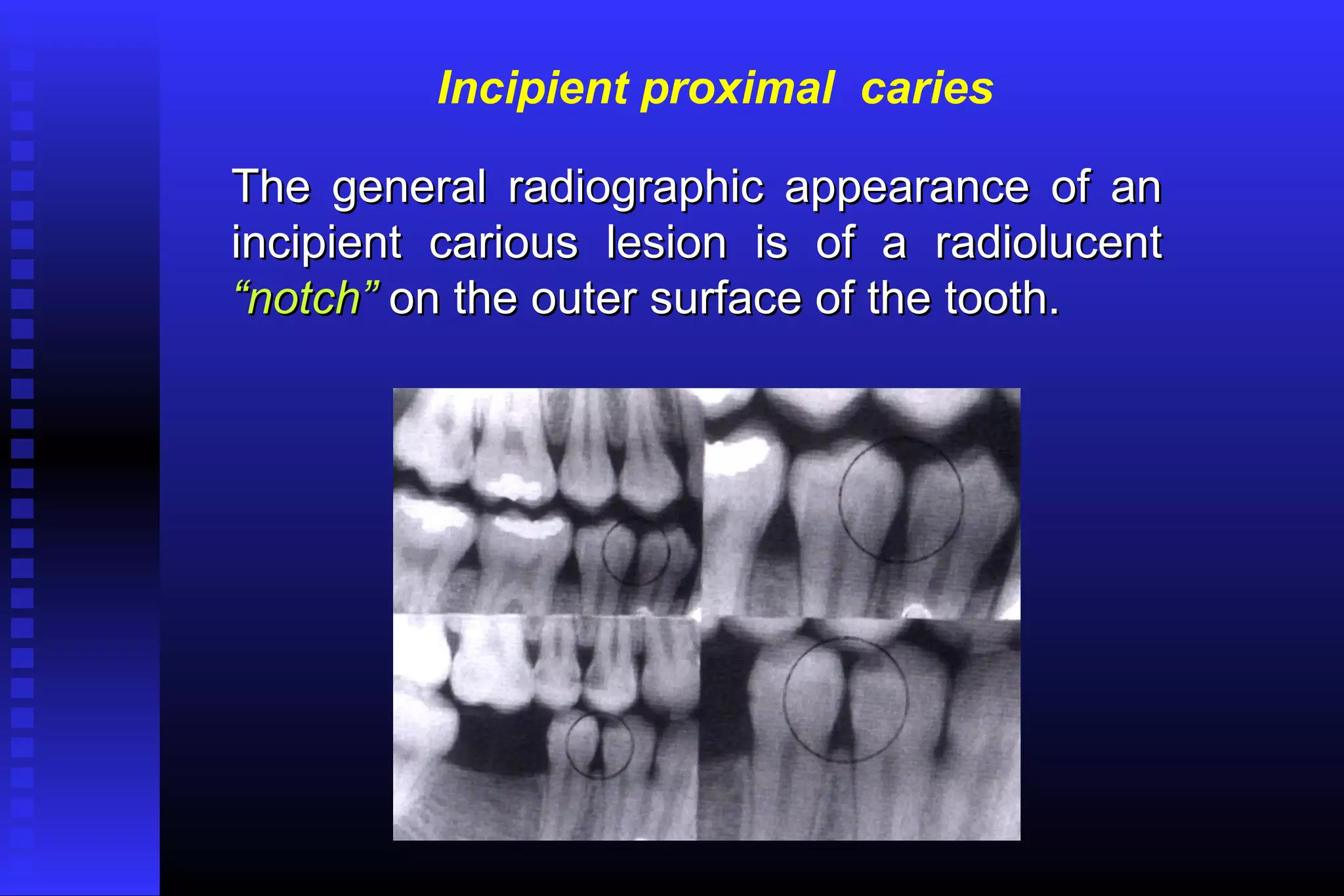 Radiographic assessment of dental caries | PPT