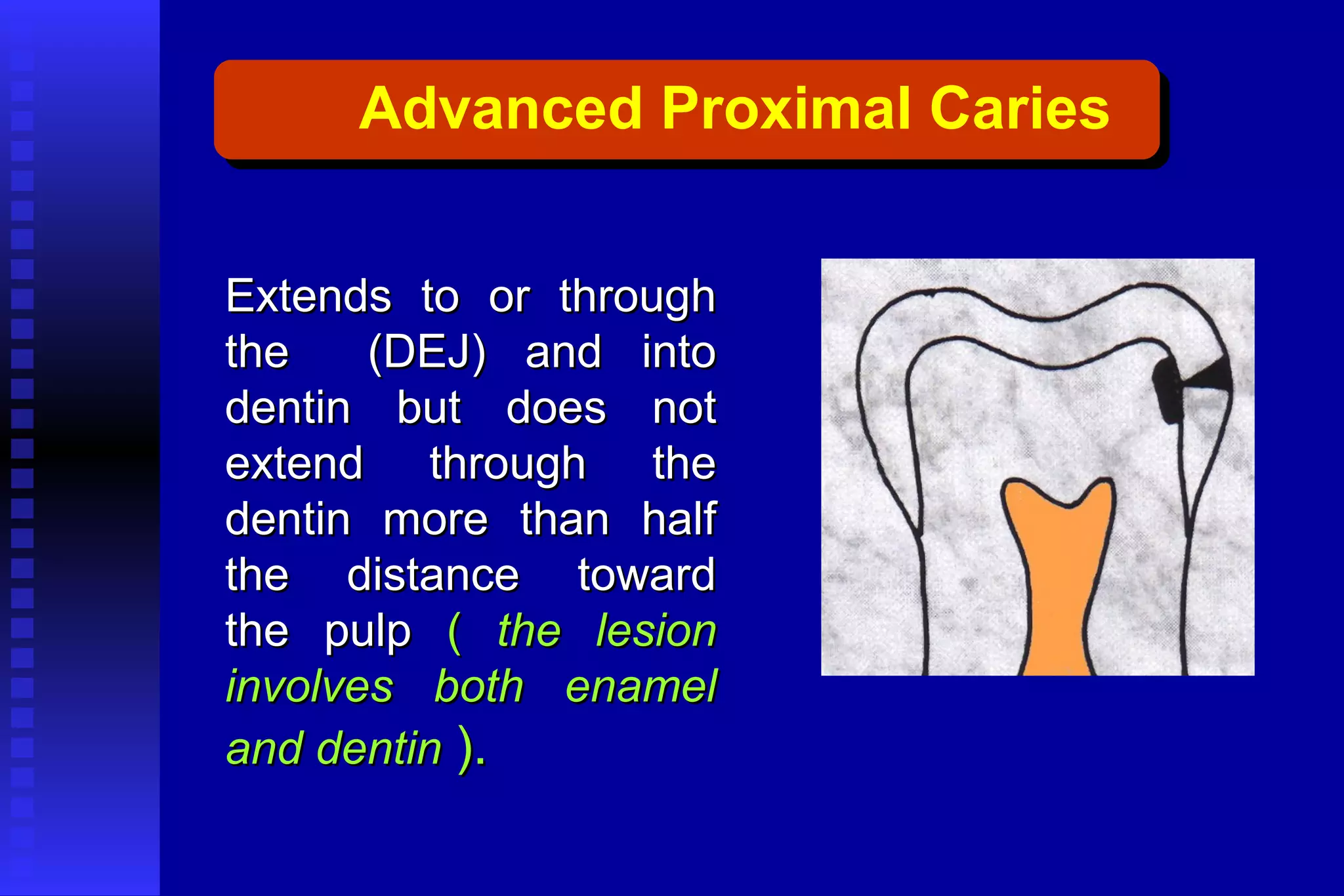 Radiographic assessment of dental caries | PPT