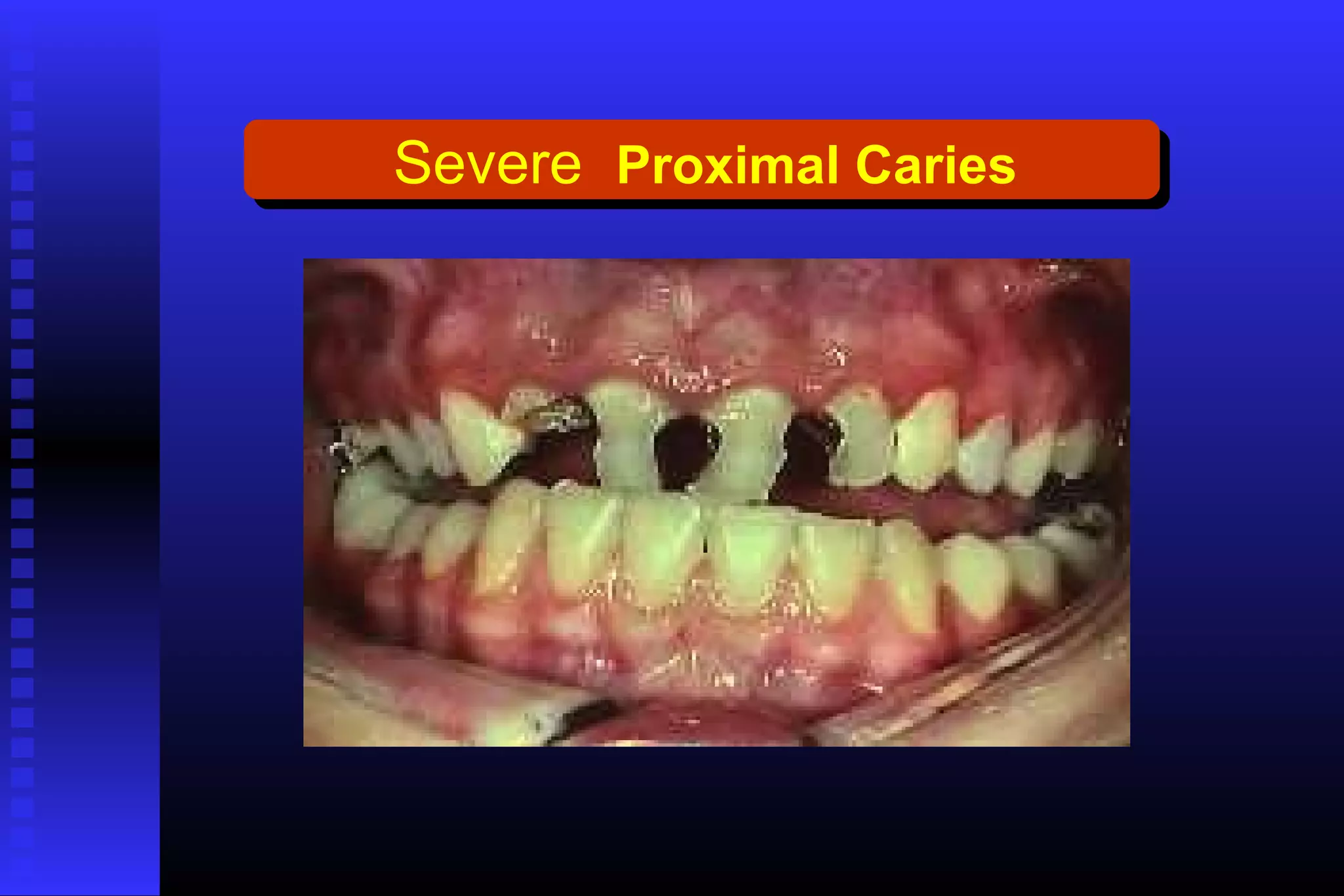Radiographic assessment of dental caries | PPT