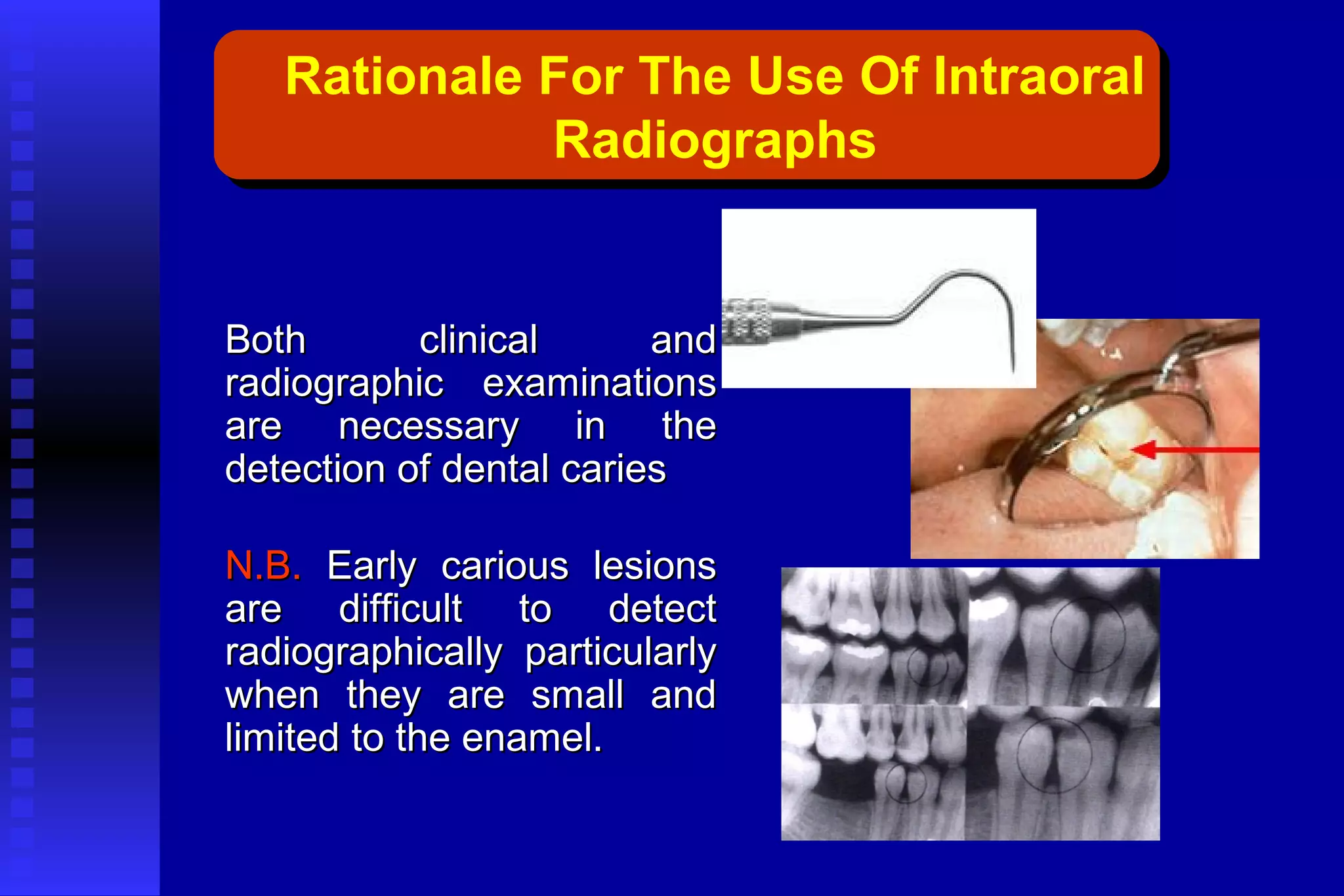 Radiographic assessment of dental caries | PPT
