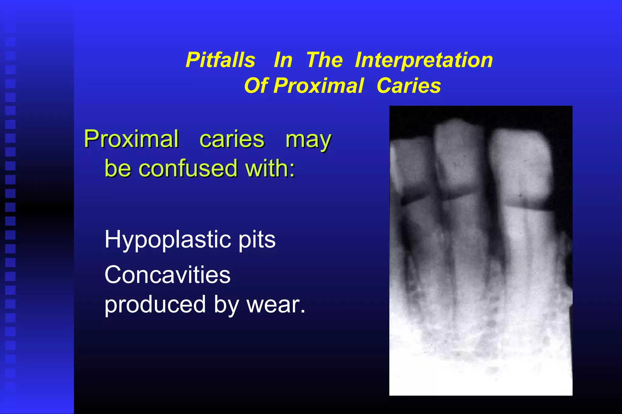 Radiographic assessment of dental caries | PPT