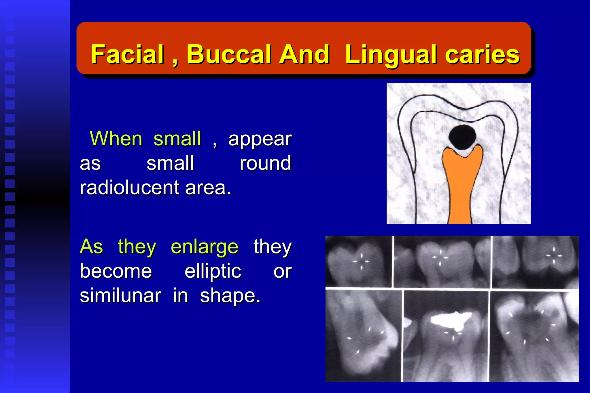 Radiographic assessment of dental caries | PPT