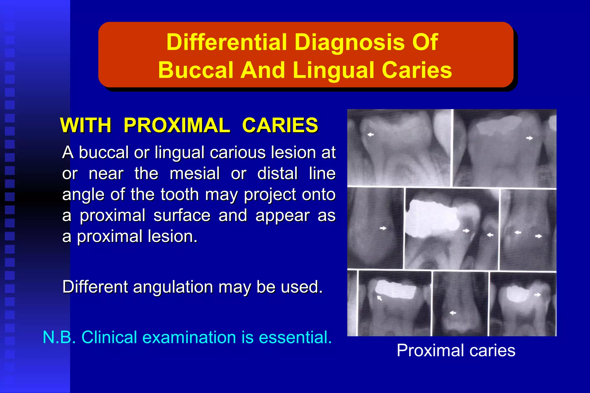 Radiographic assessment of dental caries | PPT