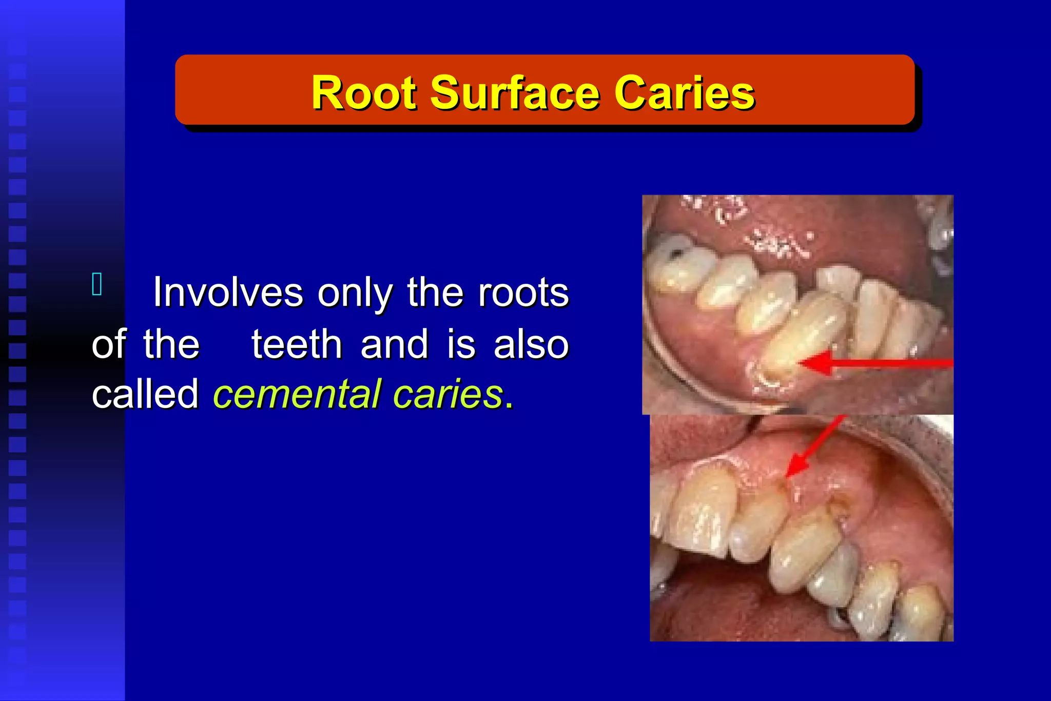 Radiographic assessment of dental caries | PPT