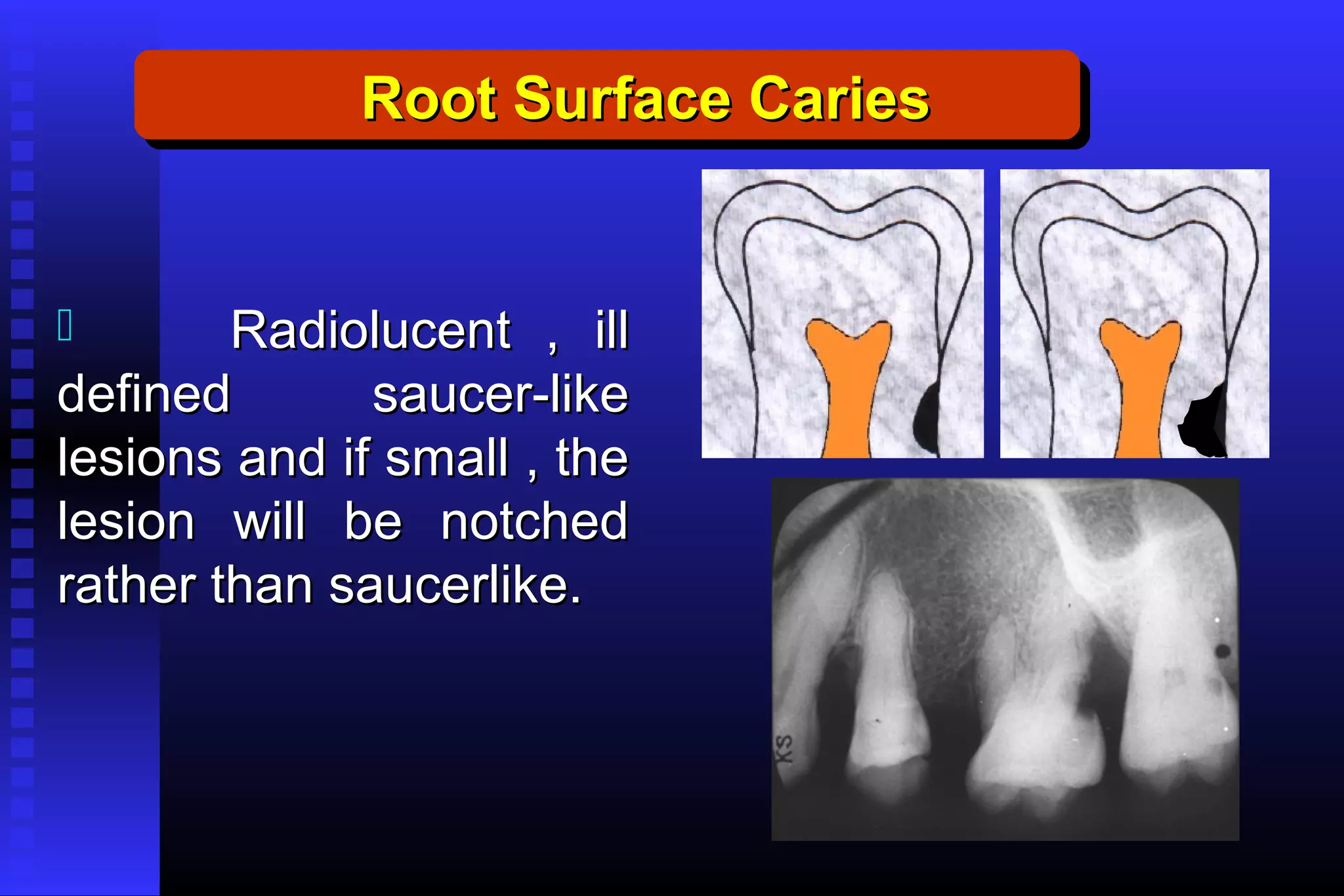 Radiographic assessment of dental caries | PPT