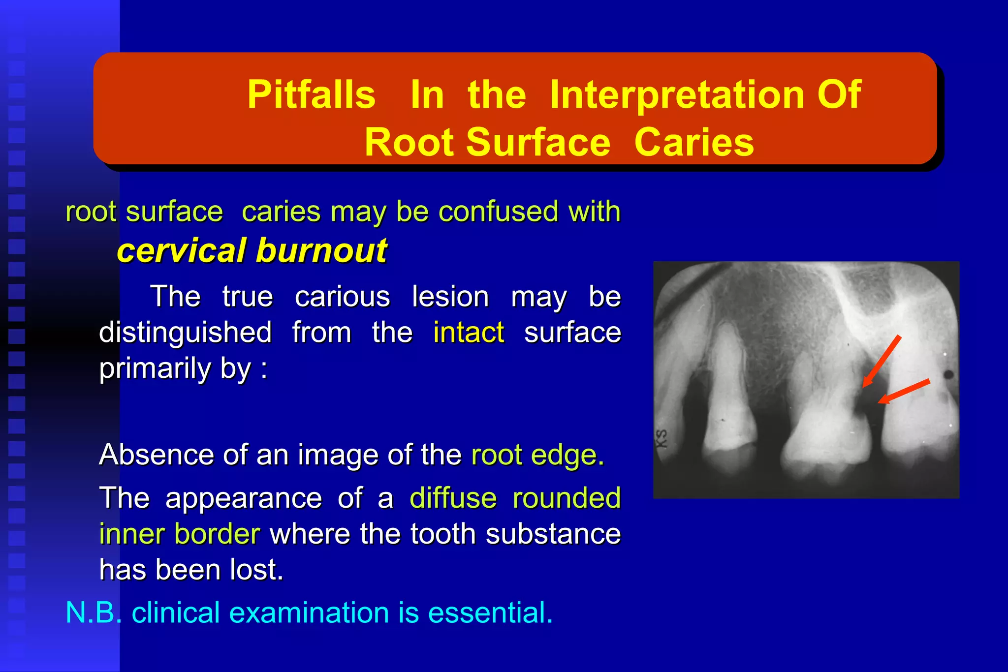 Radiographic assessment of dental caries | PPT