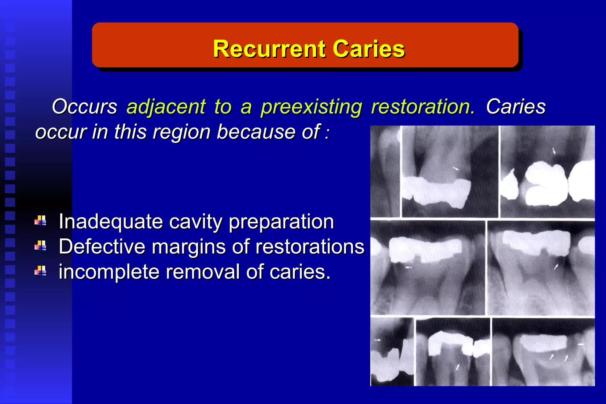 Radiographic assessment of dental caries | PPT