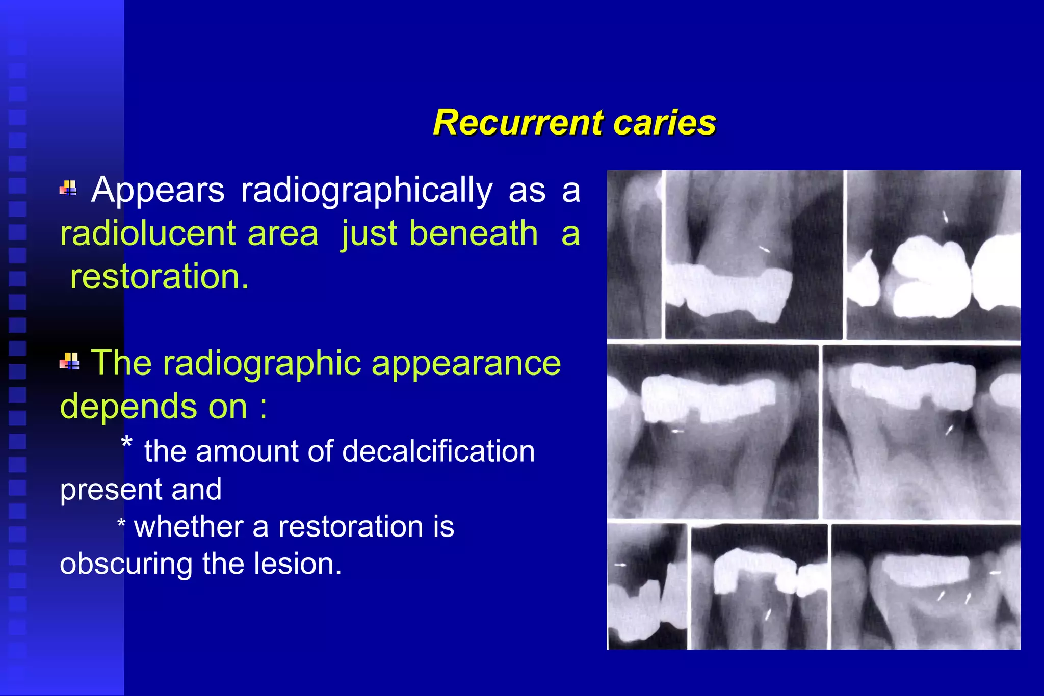Radiographic assessment of dental caries | PPT