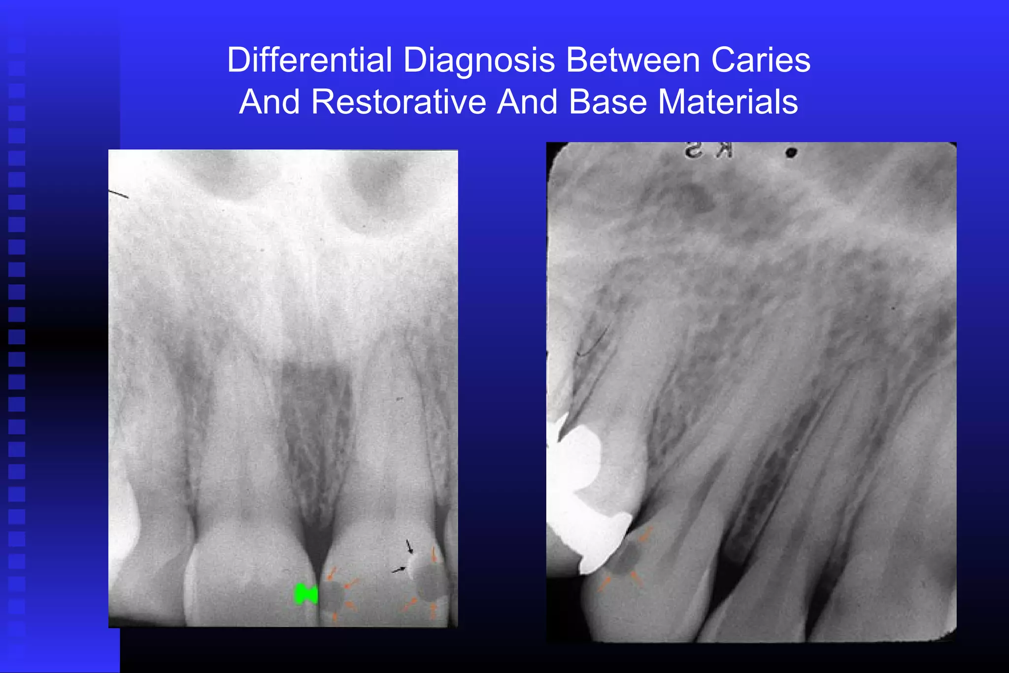Radiographic assessment of dental caries | PPT