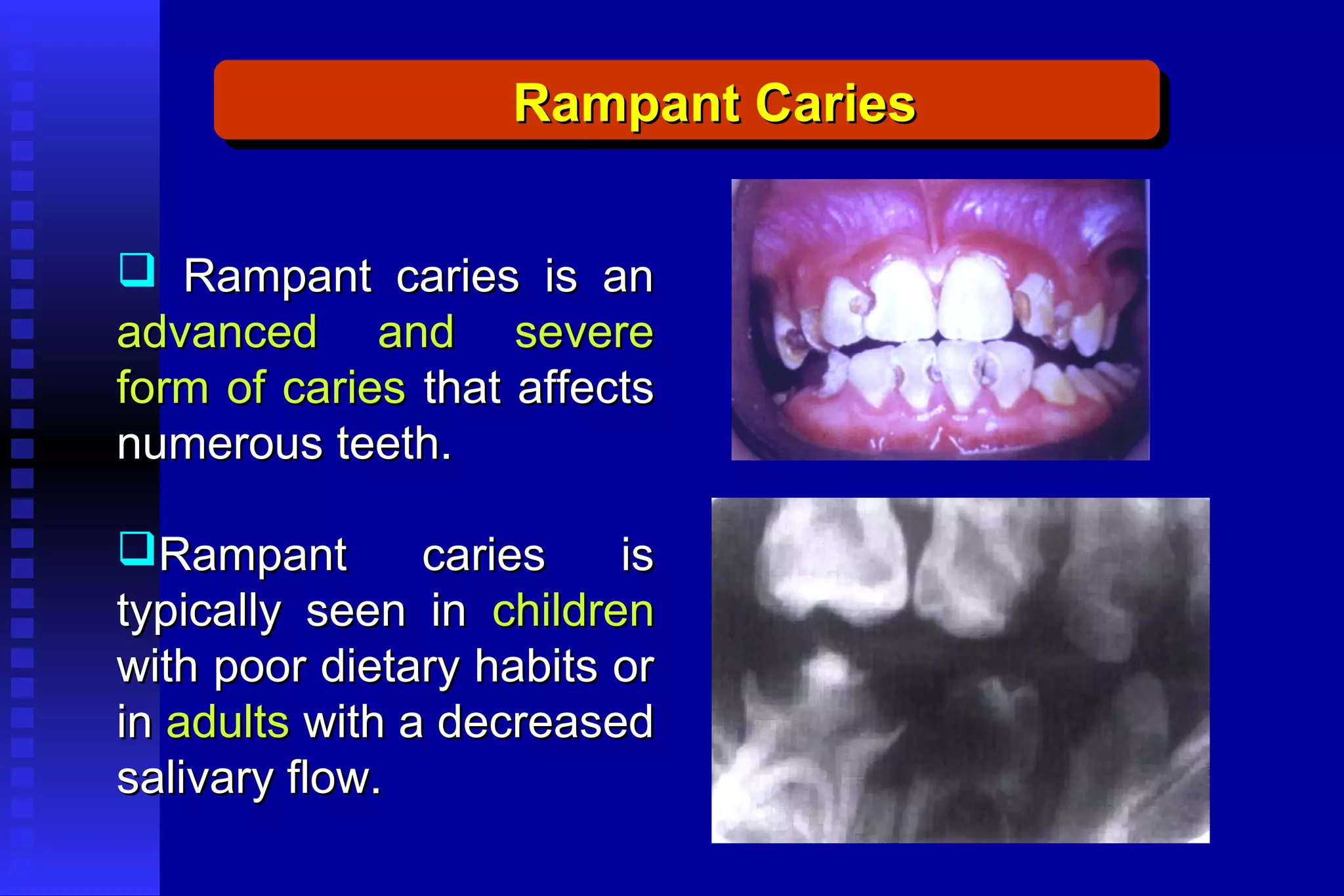 Radiographic assessment of dental caries | PPT