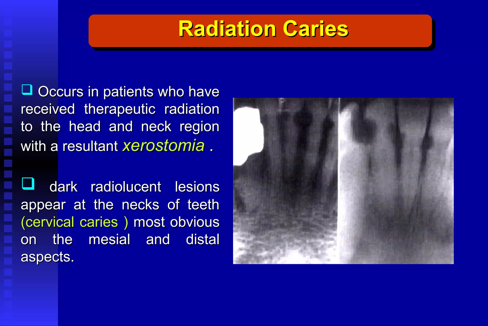 Radiographic assessment of dental caries | PPT