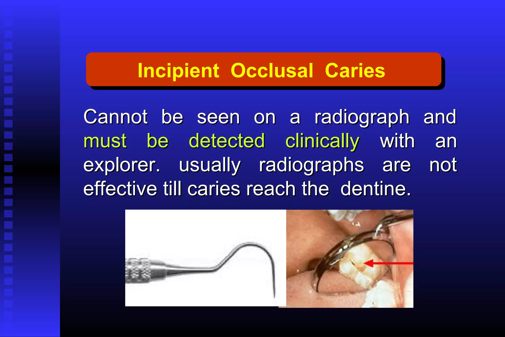 Radiographic assessment of dental caries | PPT