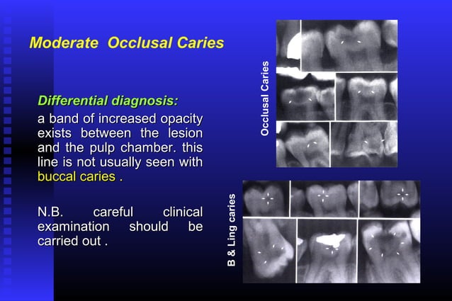 Radiographic assessment of dental caries | PPT