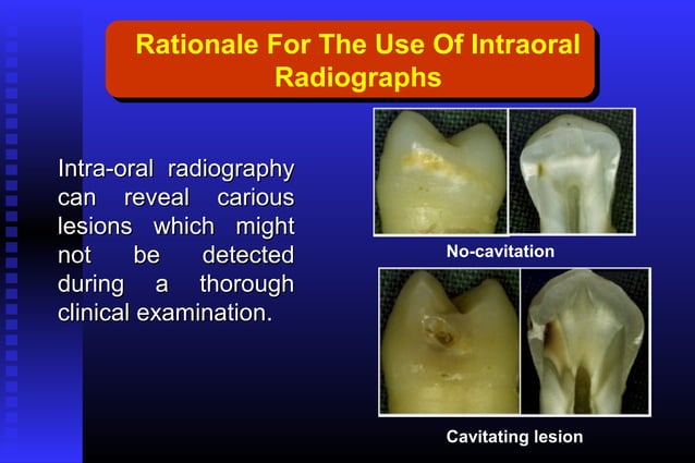 Radiographic assessment of dental caries | PPT