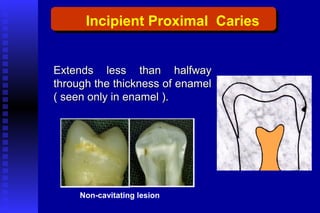 Radiographic assessment of dental caries | PPT