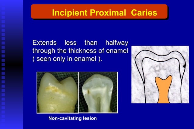 Radiographic assessment of dental caries | PPT