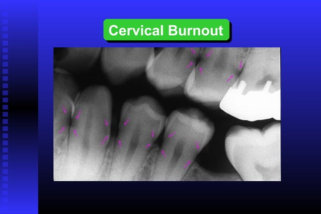 Radiographic assessment of dental caries | PPT
