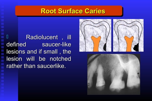 Radiographic assessment of dental caries | PPT