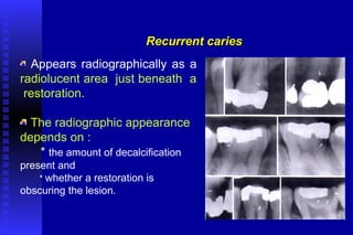 Radiographic assessment of dental caries | PPT