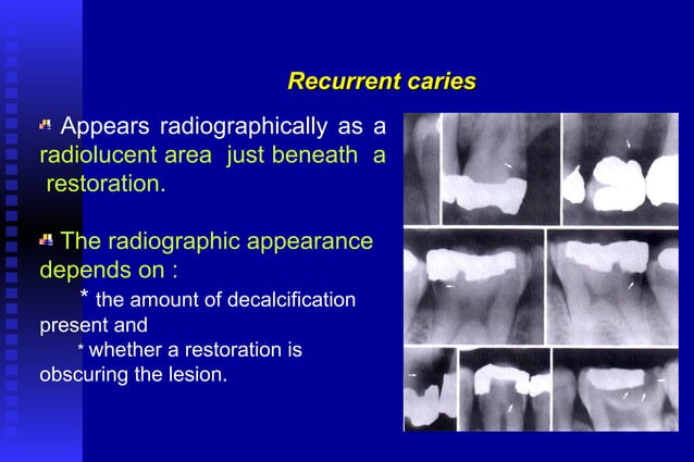 Radiographic assessment of dental caries | PPT