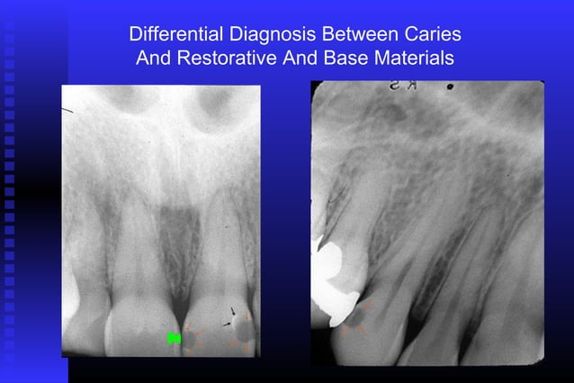 Radiographic assessment of dental caries | PPT