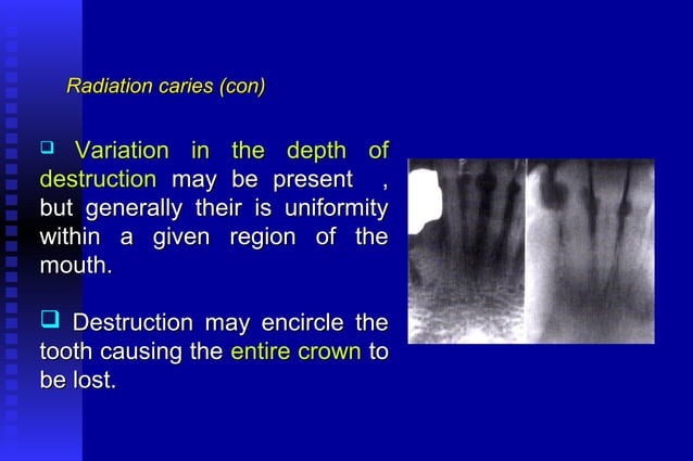Radiographic assessment of dental caries | PPT