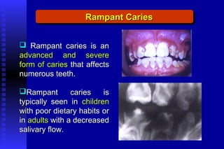 Rampant Caries Radiograph