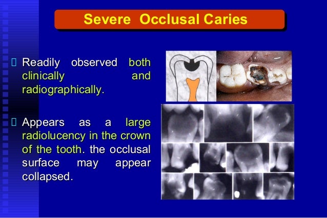Radiographic assessment of dental caries