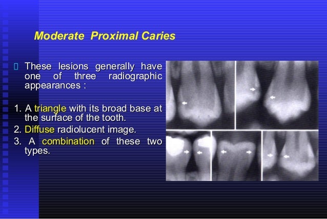Radiographic assessment of dental caries