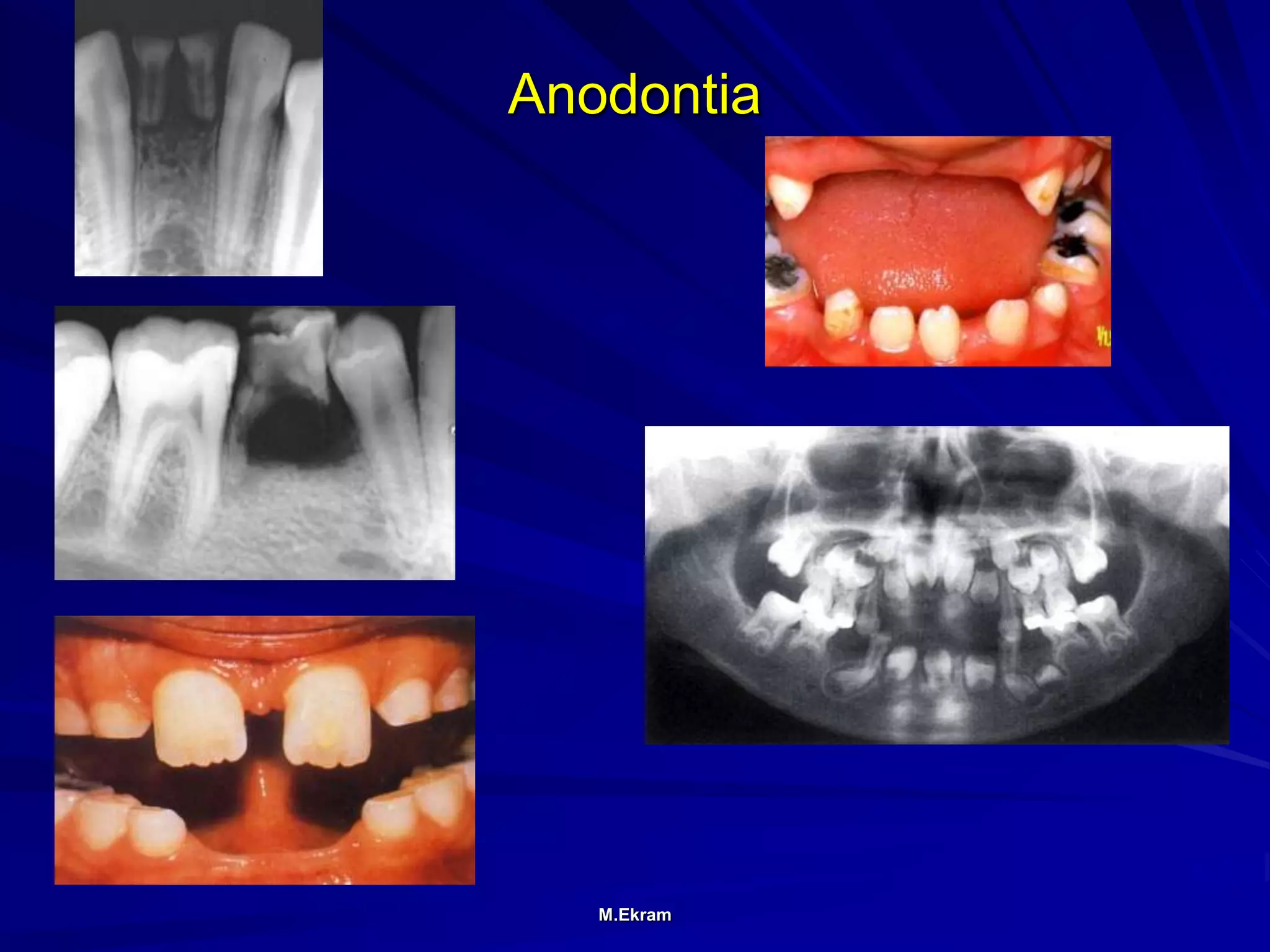 Radiographic assessment of teeth developmental anomalies | PPT