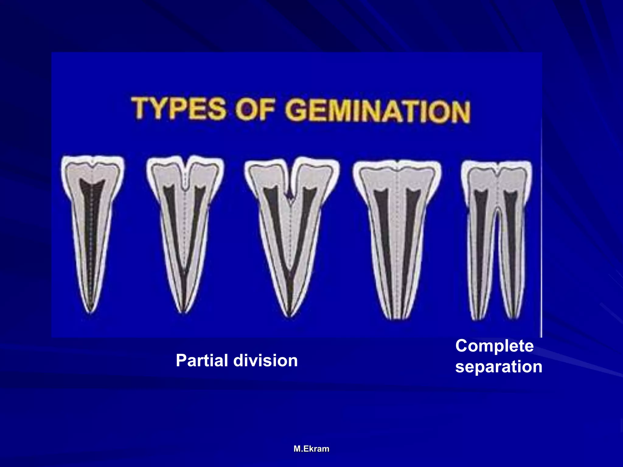 Radiographic assessment of teeth developmental anomalies | PPT
