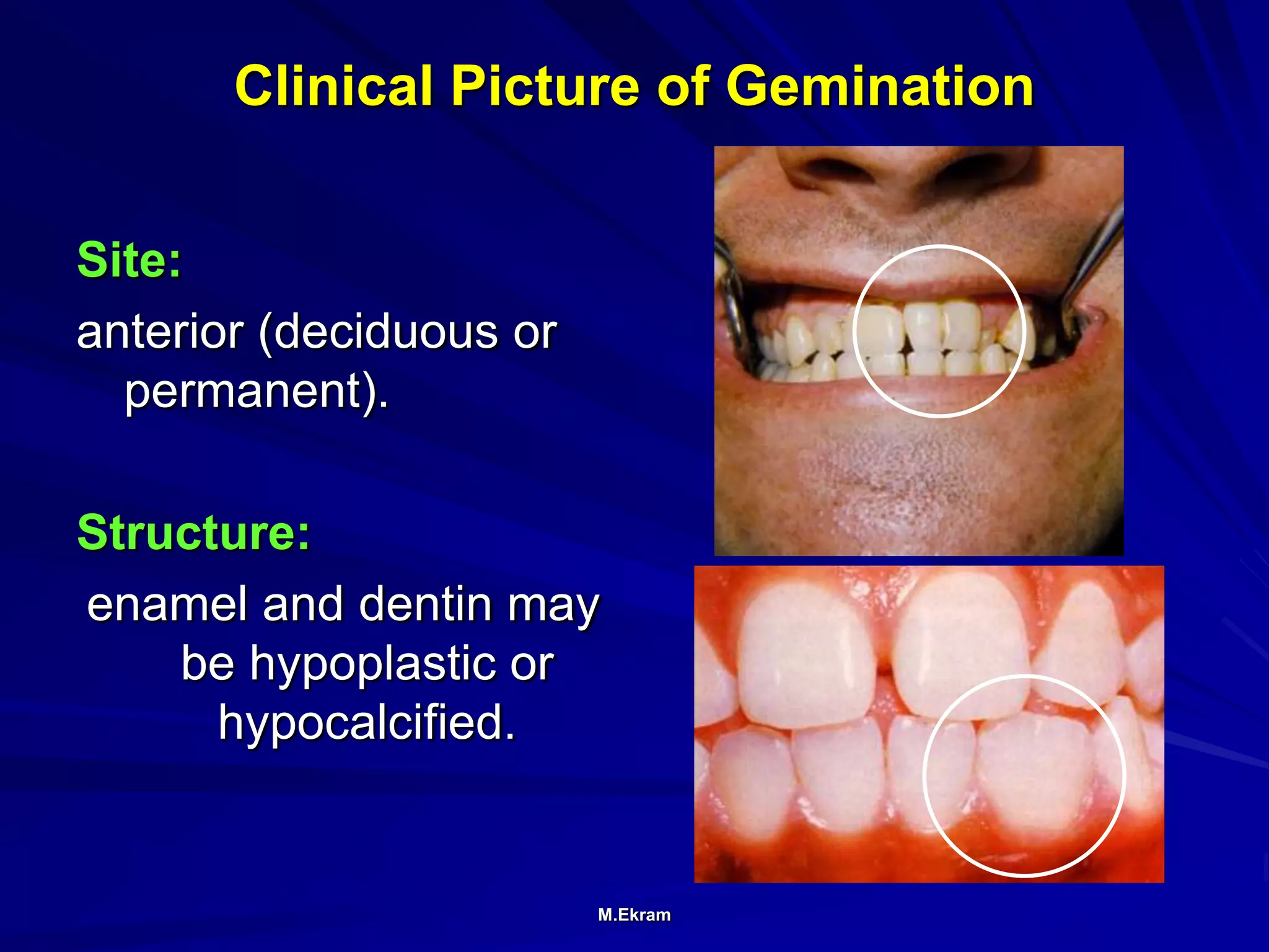 Radiographic assessment of teeth developmental anomalies | PPT