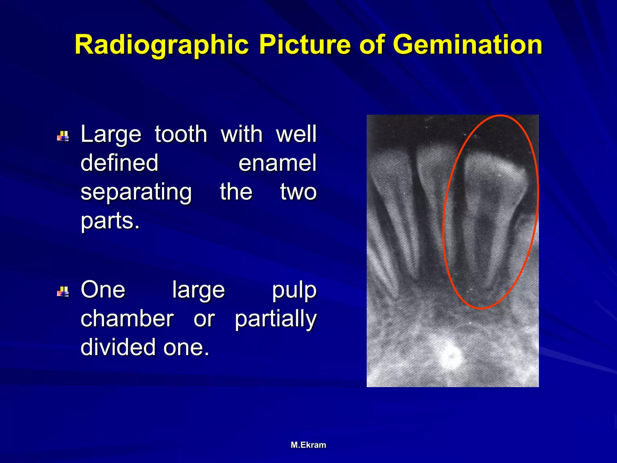 Radiographic assessment of teeth developmental anomalies | PPT