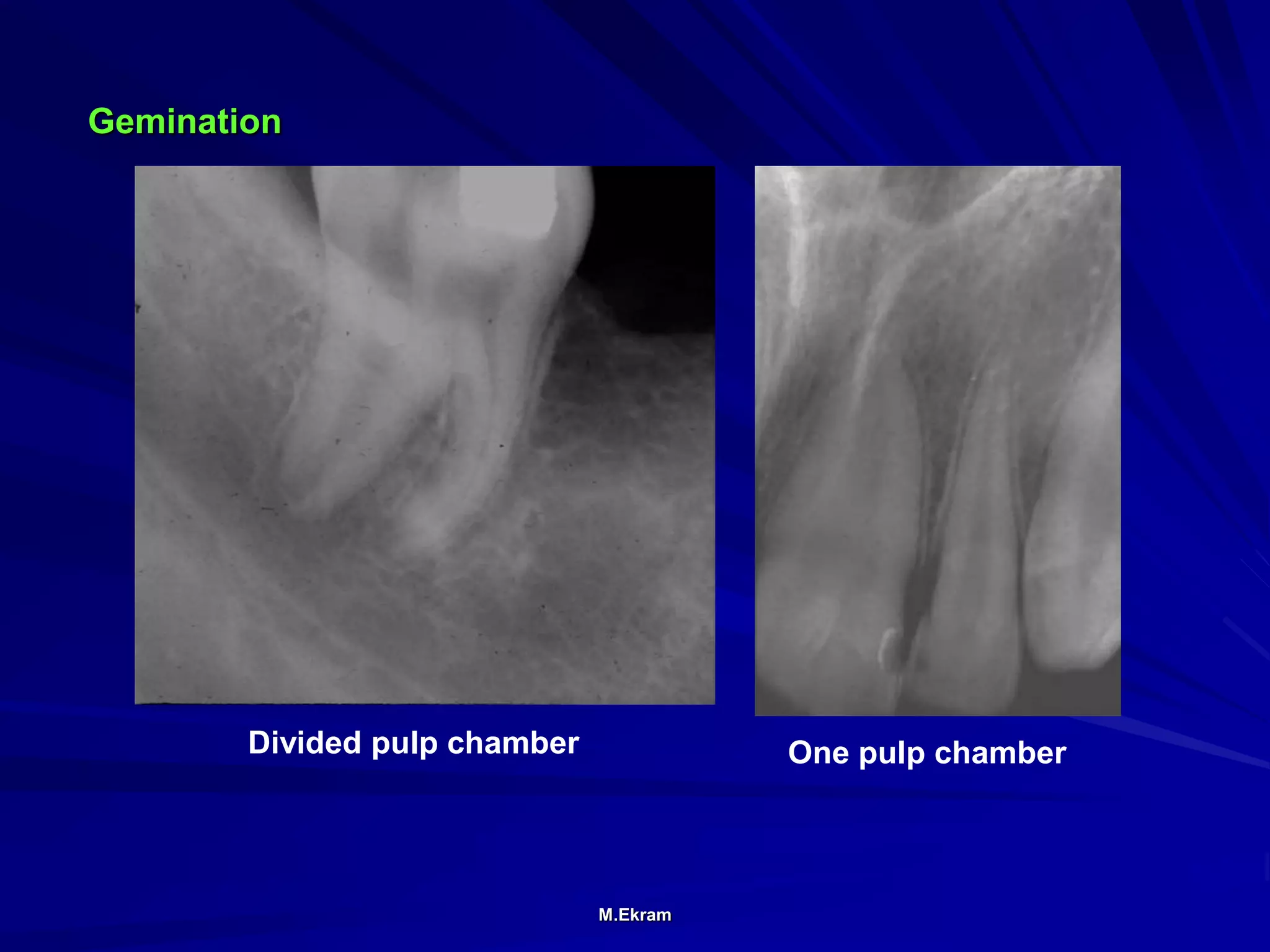 Radiographic assessment of teeth developmental anomalies | PPT