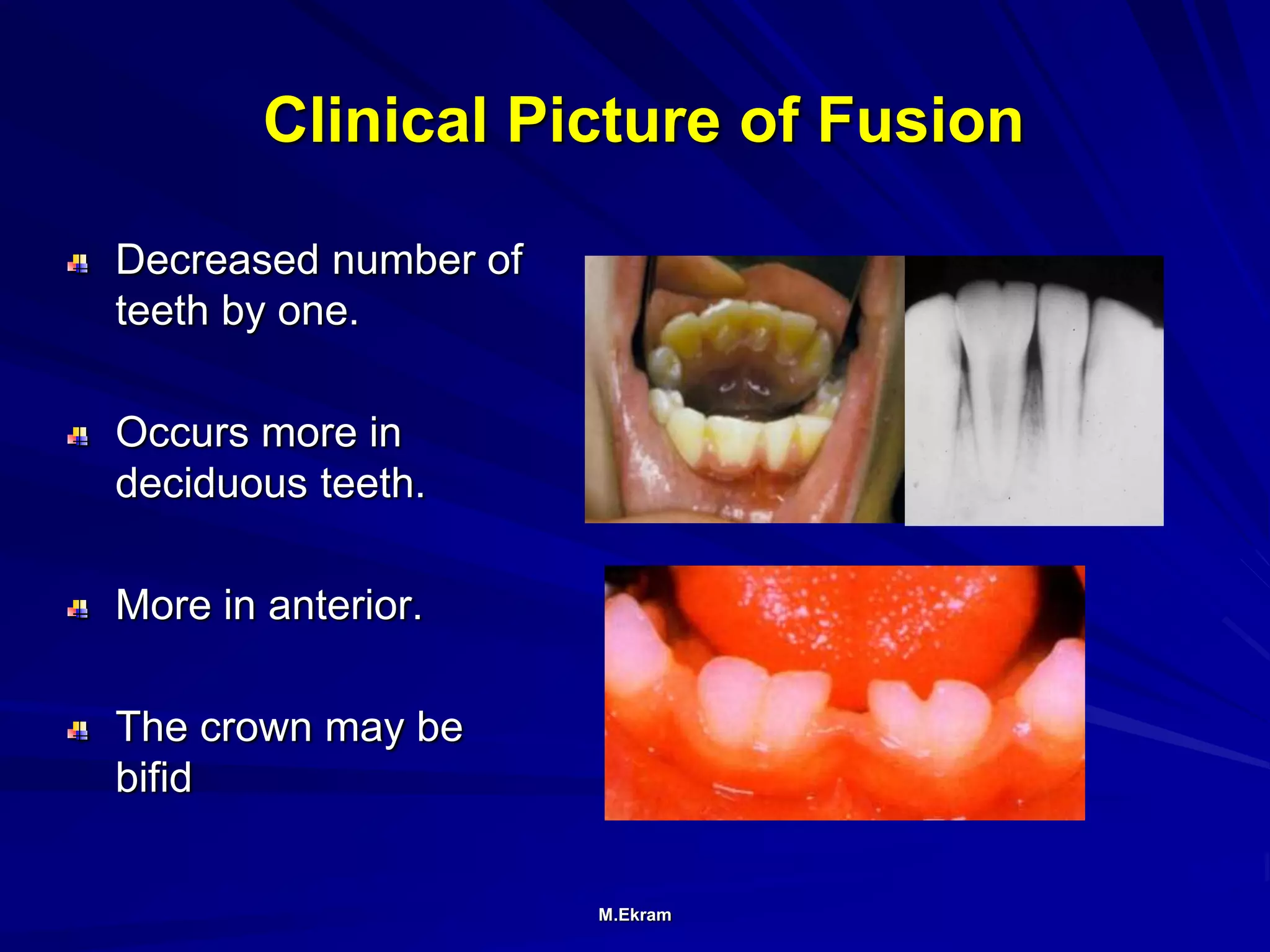 Radiographic assessment of teeth developmental anomalies | PPT