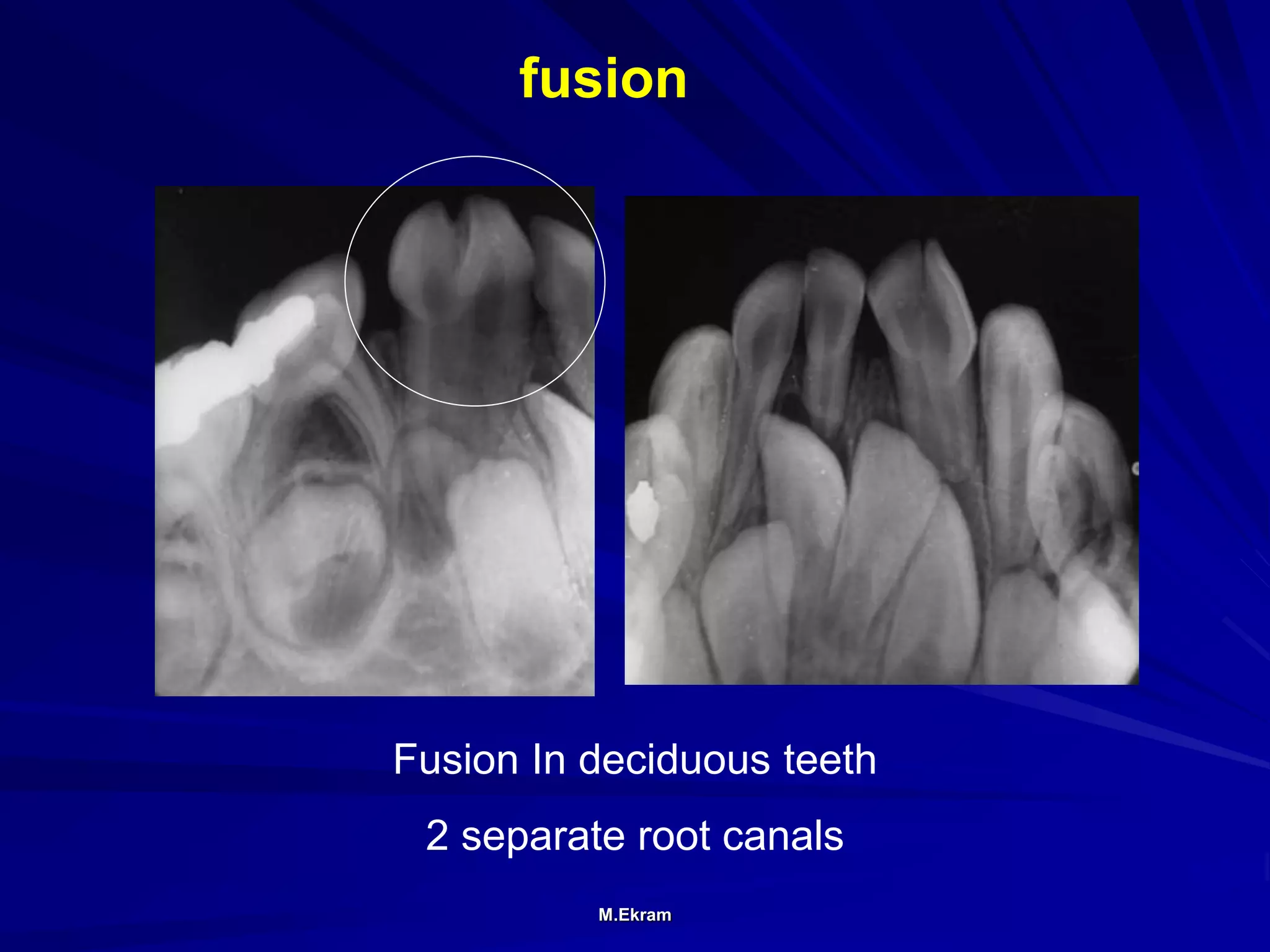 Radiographic assessment of teeth developmental anomalies | PPT