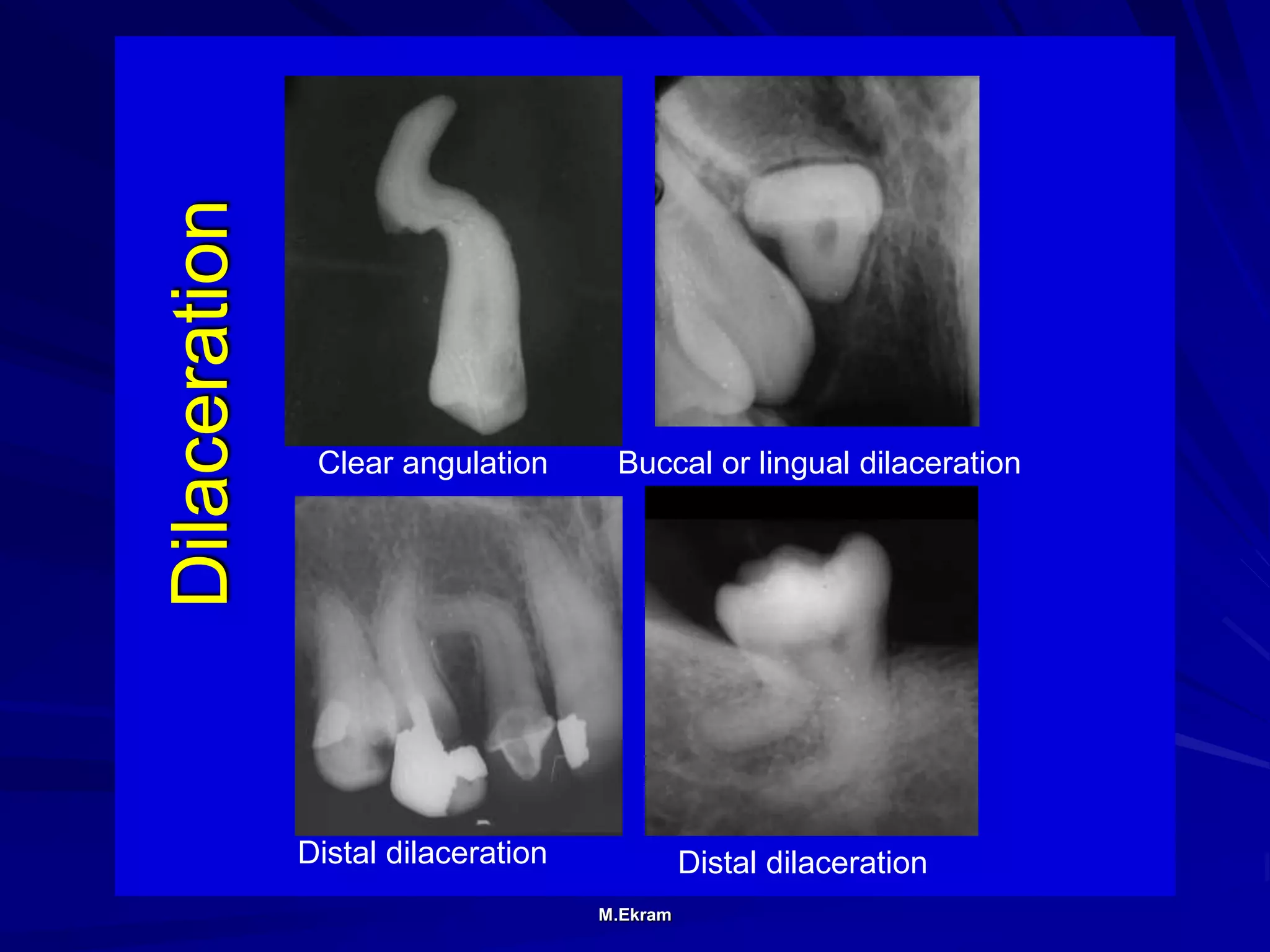 Radiographic assessment of teeth developmental anomalies | PPT