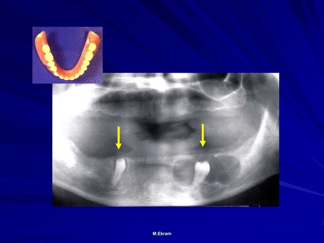 Radiographic assessment of teeth developmental anomalies | PPT