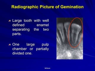 Radiographic assessment of teeth developmental anomalies | PPT