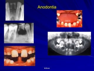 Anodontia Radiograph
