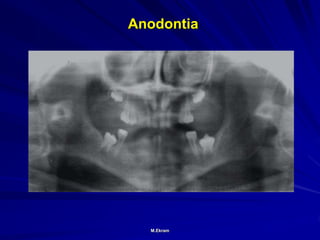 Anodontia Radiograph
