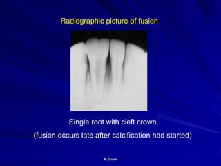 Fusion Teeth Radiograph