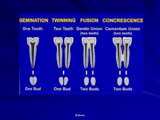 Fusion Teeth