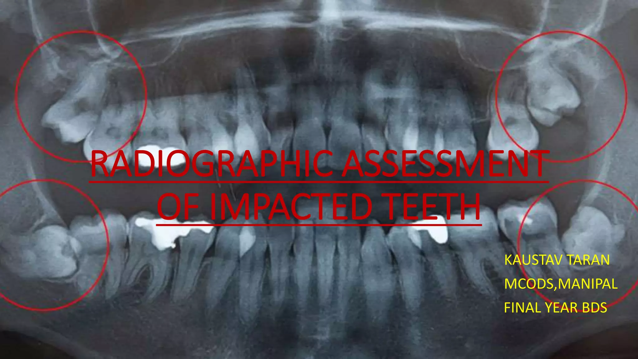 Radiographic assessment of impacted teeth | PPTX